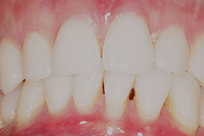Smile Gallery | Dr. Friedberg, Periodontist, in Houston, TX