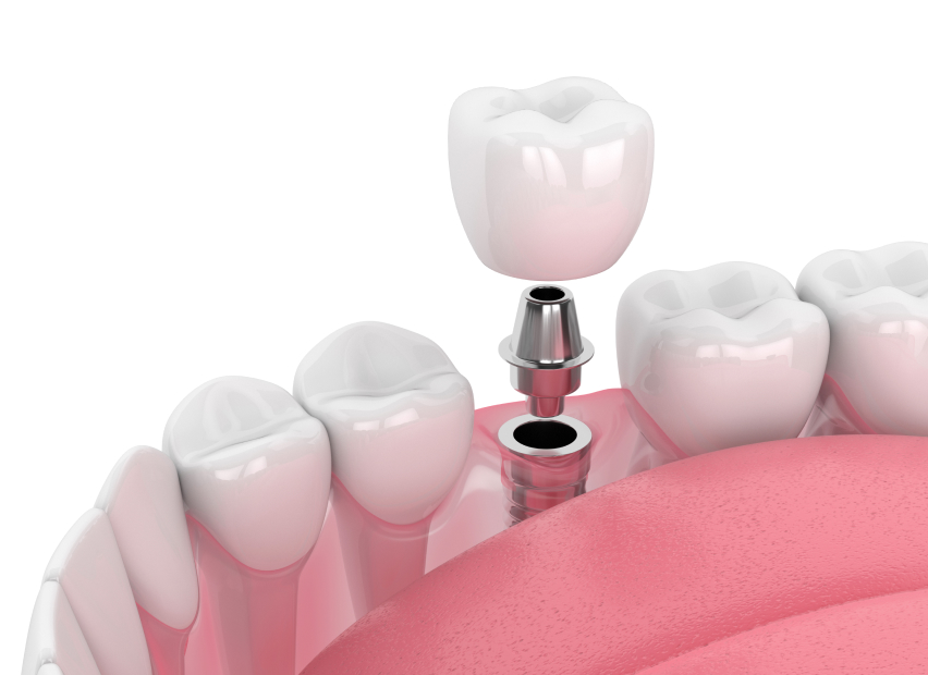 Dantų implantacija