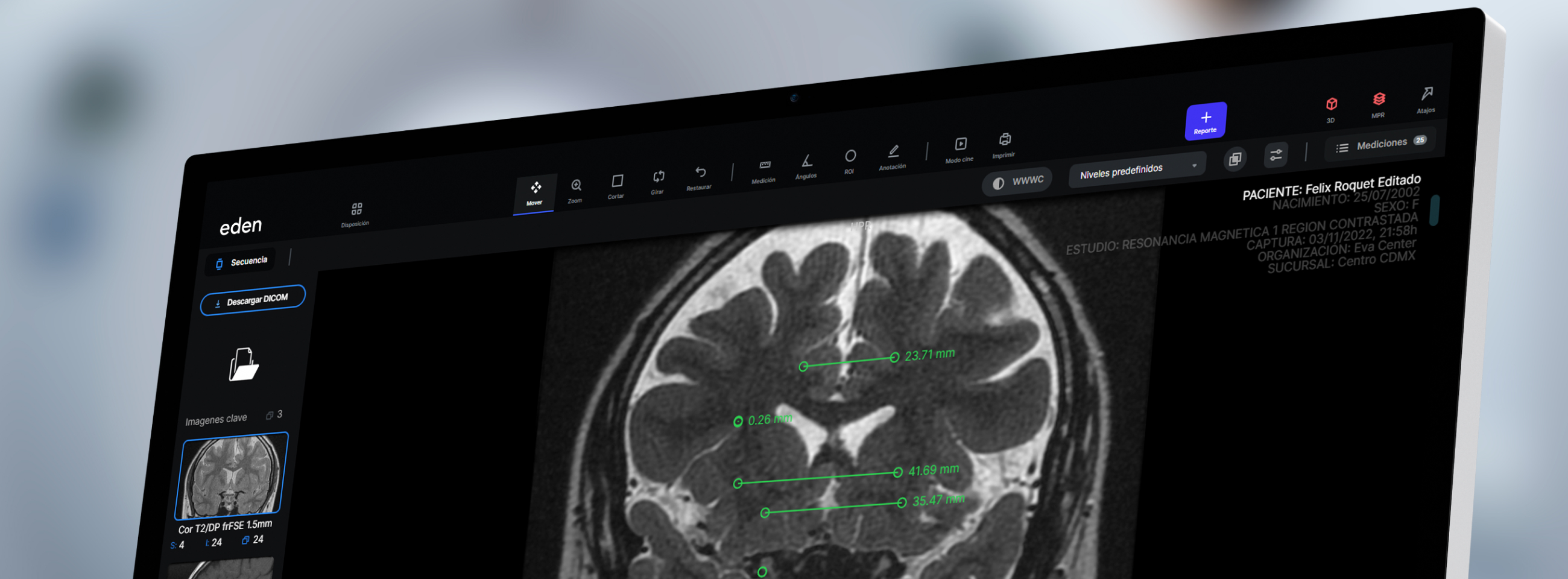 ¿Qué es un sistema PACS y qué significa PACS? - Eva
