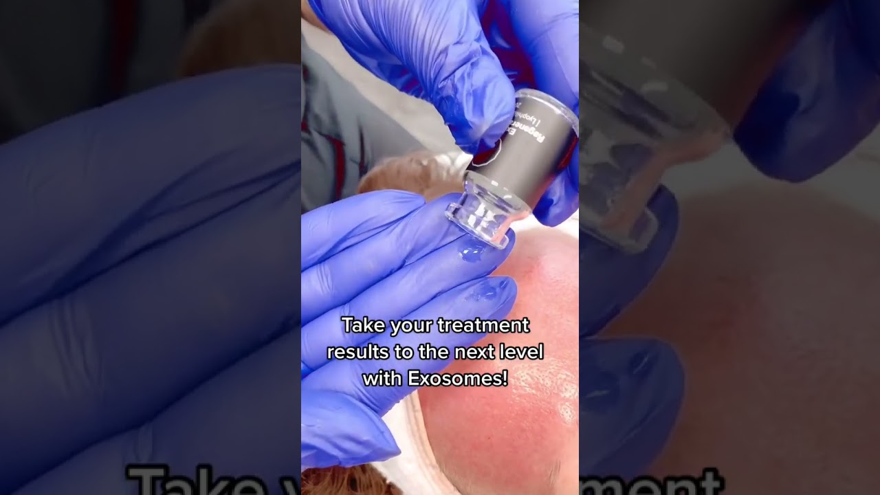 Topical Exosomes to Improve Treatment Results | Enhance Aesthetics Winnepeg