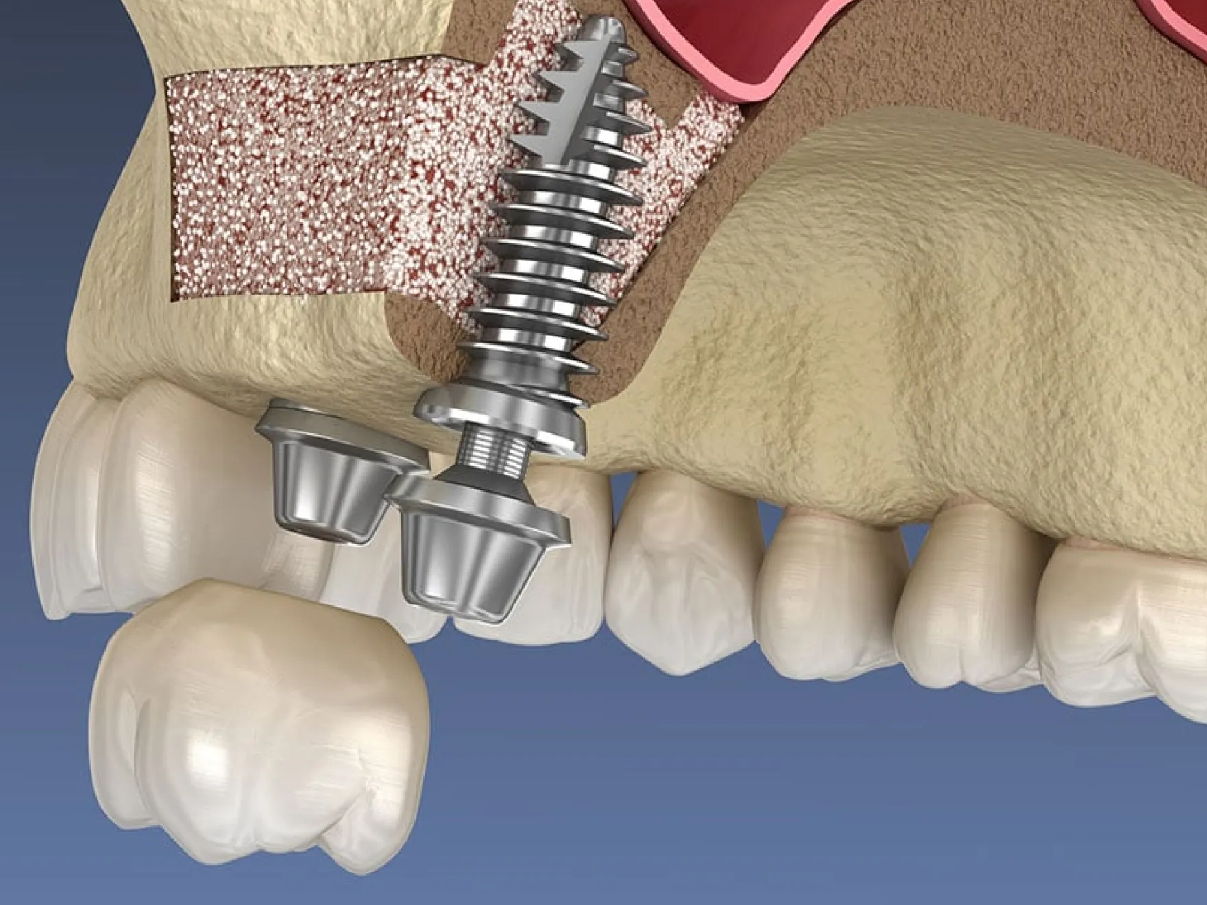 Oral Surgery Procedures in Mt Airy, MD