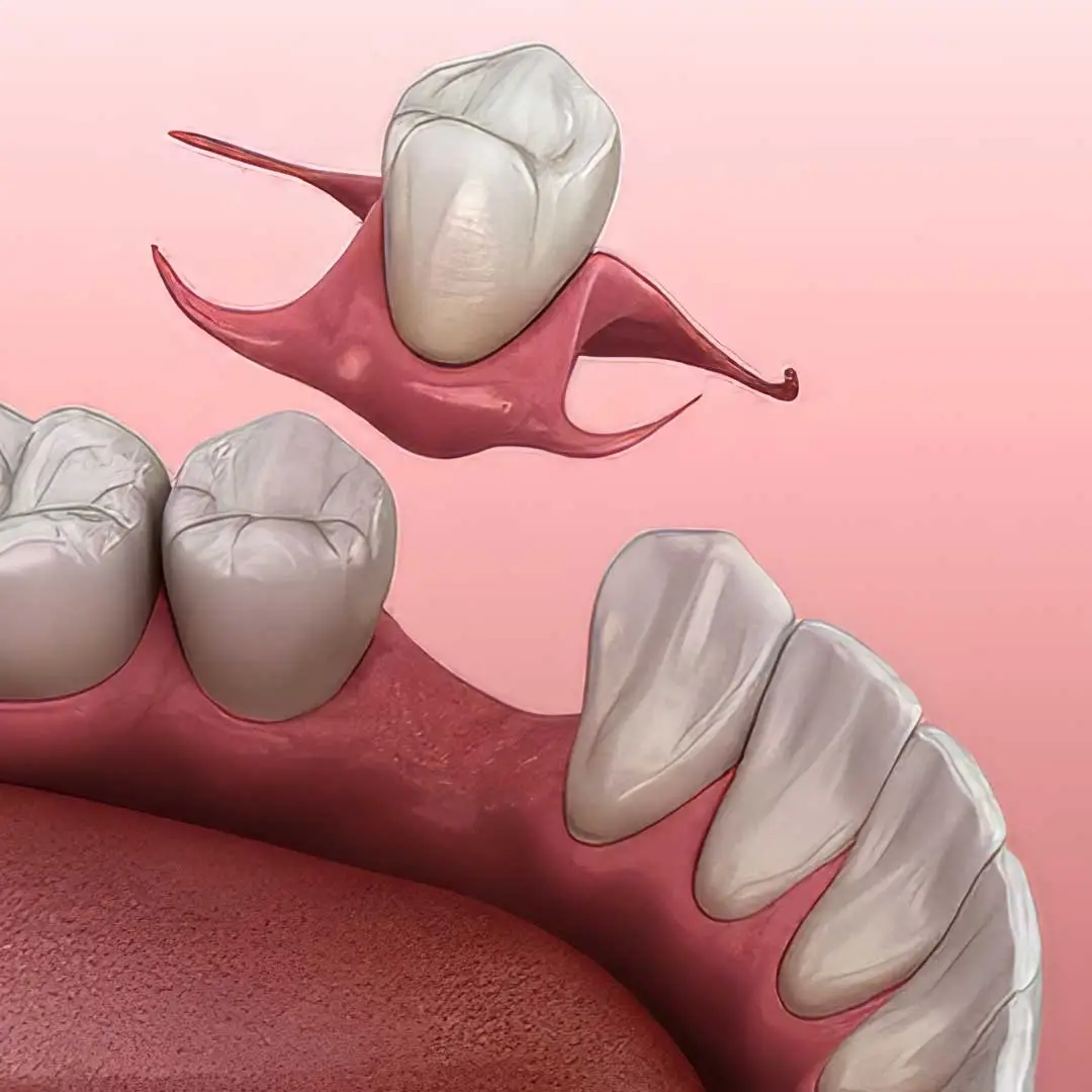 Single-tooth partial solutions for your smile. | New Smile Dentures