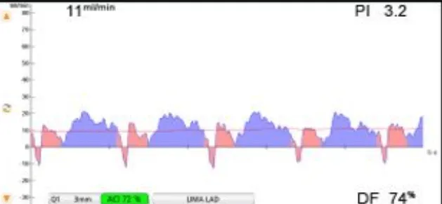 MiraQ™ Cardiac: Precision Cardiac Surgery System | Medistim