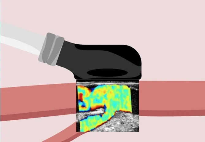 MiraQ™ Vascular: Advanced Vascular Surgery Technology | Medistim