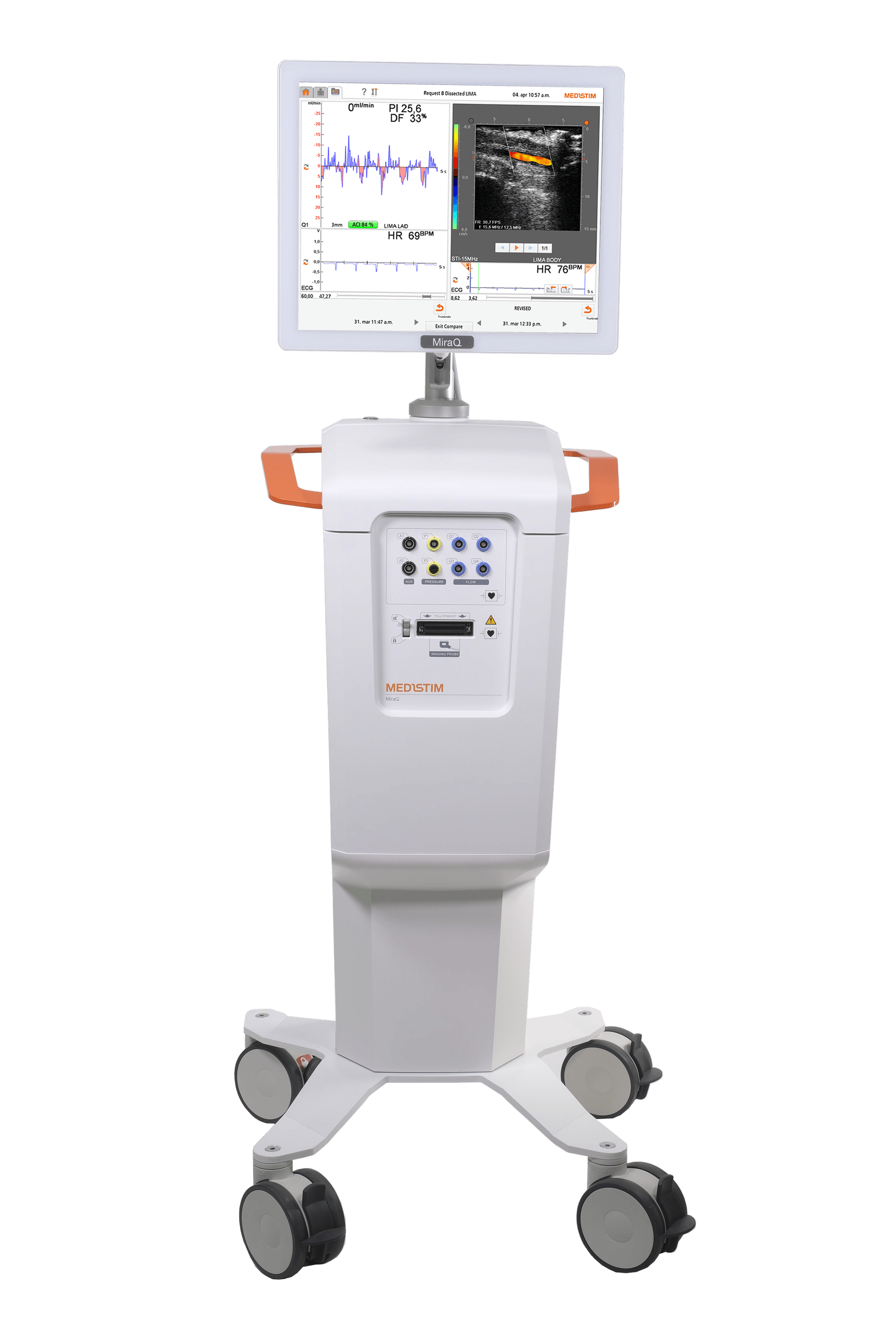 Medistim: Pioneers of TTFM Transit Time Flow Measurement Technology