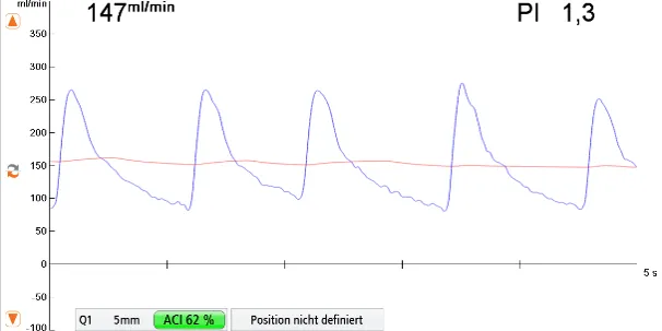 MiraQ™ Vascular: Advanced Vascular Surgery Technology | Medistim