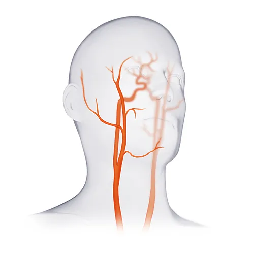 MiraQ™ Vascular: Advanced Vascular Surgery Technology | Medistim