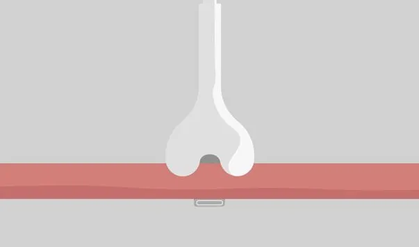 Vascular Surgery Resource Hub: Techniques & Patient Care | Medistim