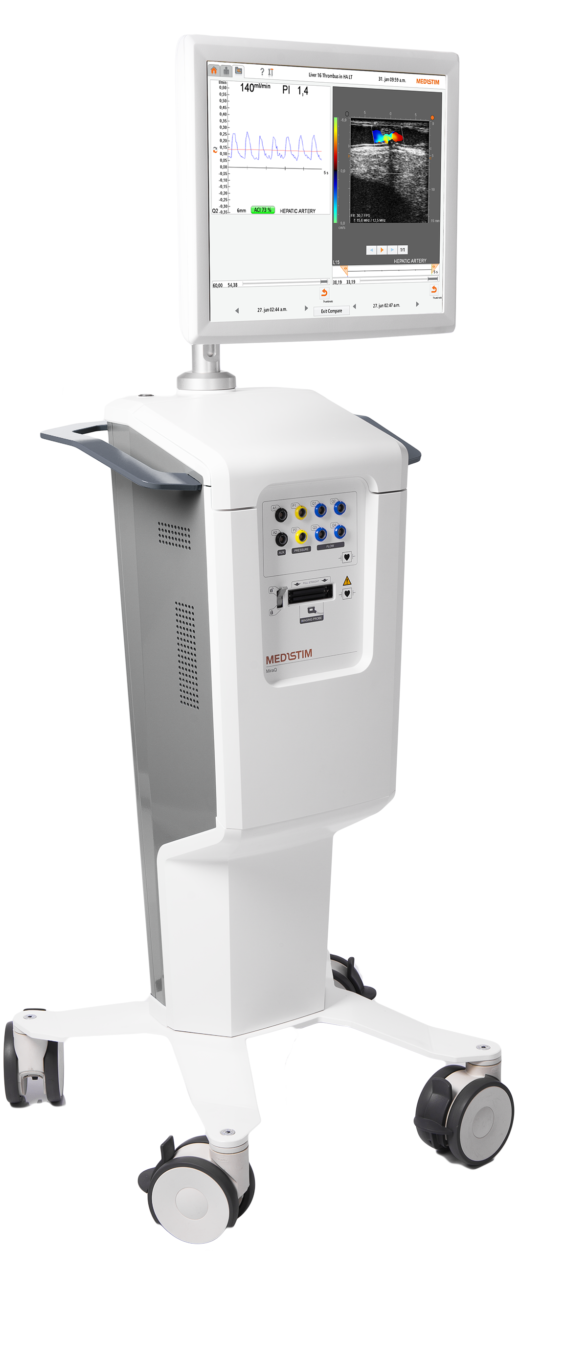 MiraQ Ultimate: Intraoperative System for Cardiac Vascular Transplant