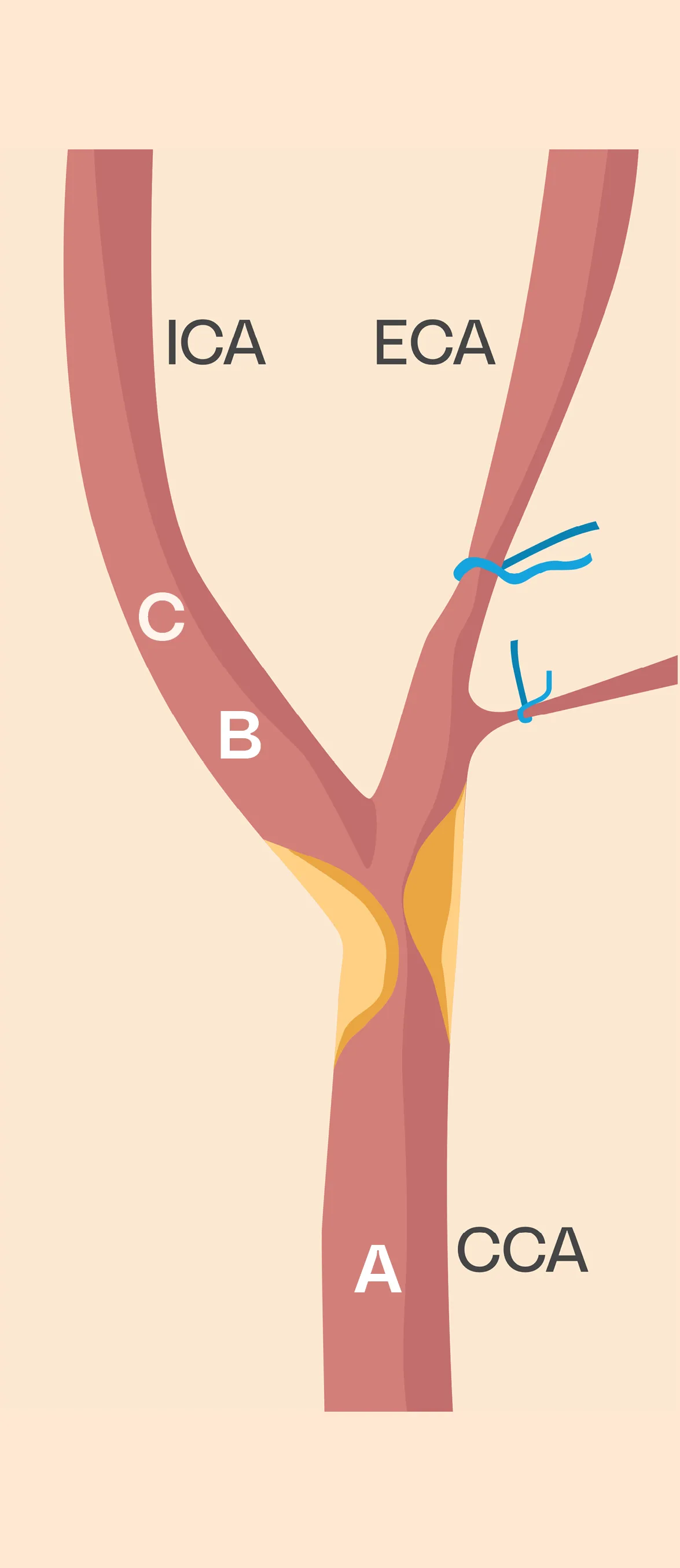 Vascular Surgery Resource Hub: Techniques & Patient Care | Medistim