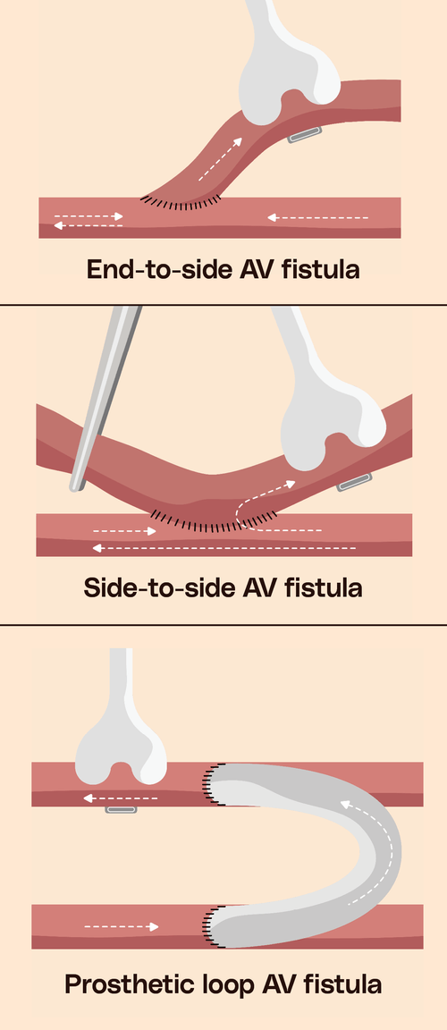Vascular Surgery Resource Hub: Techniques & Patient Care | Medistim