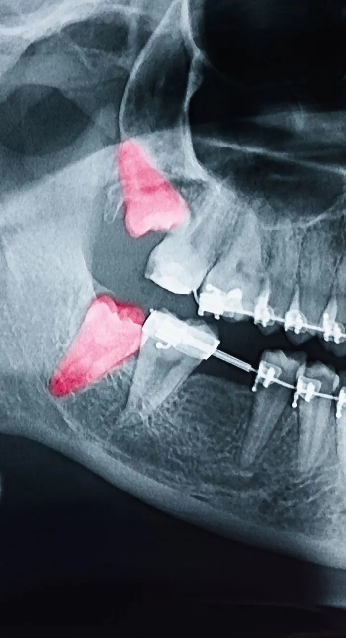 Tooth Extractions in Riverside | Smile Pathway Dental