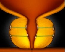 UroLift | Florida Urology Partners