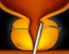 UroLift | Florida Urology Partners