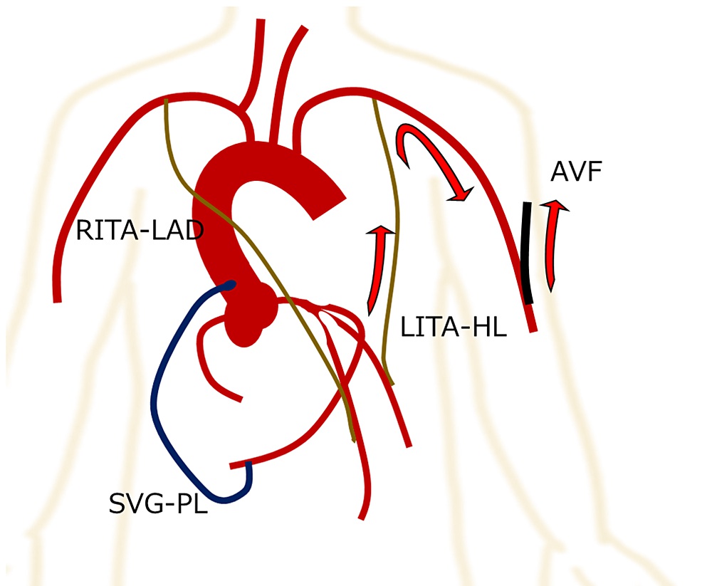 Medistim: TTFM's Role in Subclavian Steal Syndrome Management