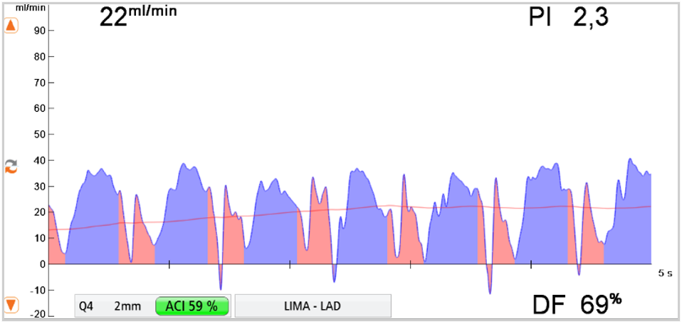 LIMA Hematoma Detection: TTFM & HFUS by Medistim