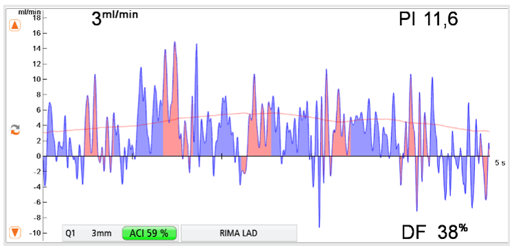 Graft Patency Verification: TTFM & HFUS Insights | Medistim
