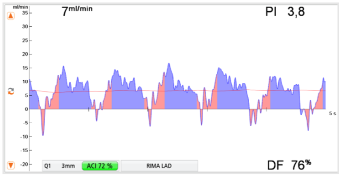 Graft Patency Verification: TTFM & HFUS Insights | Medistim