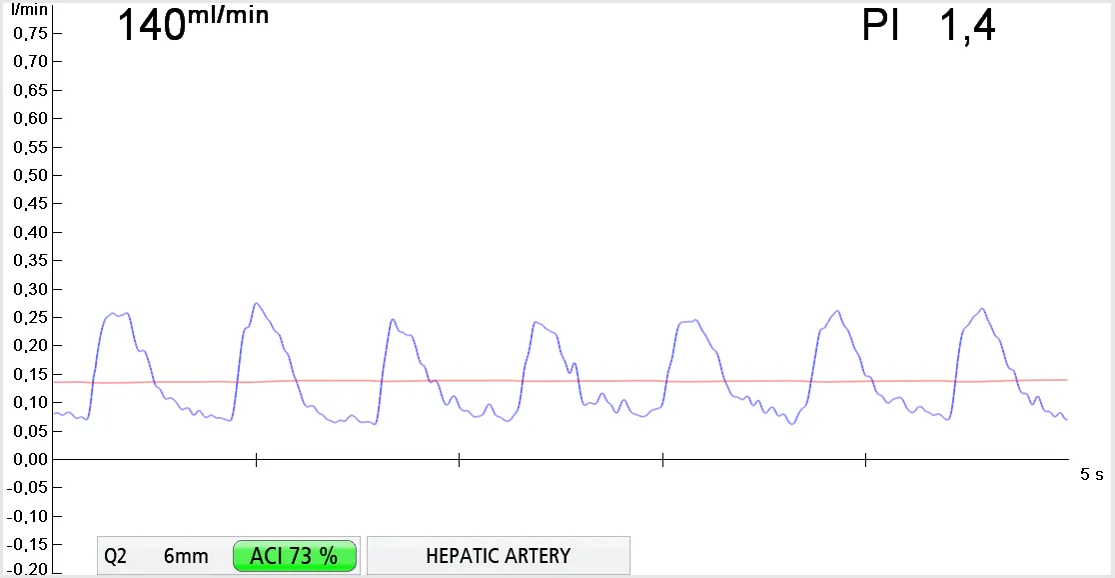 HFUS Detects Hepatic Artery Thrombus | Medistim