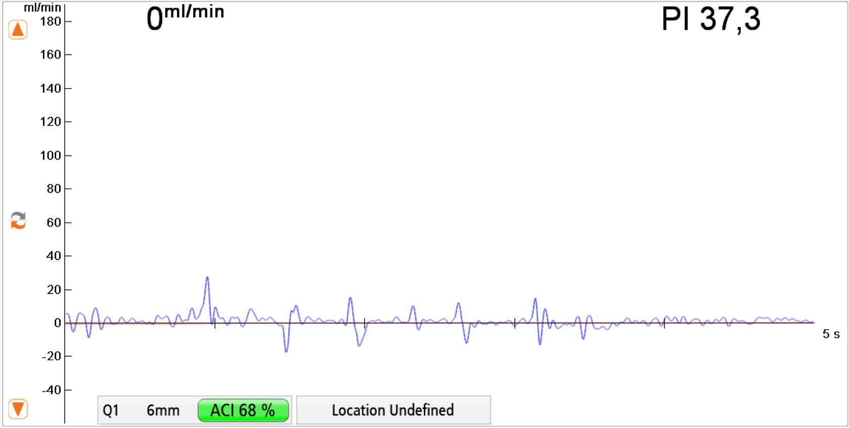 Detect Thrombus: TTFM & HFUS in Meso-Rex Shunt