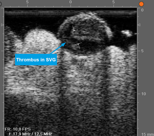 Detect Thrombus: TTFM & HFUS in Meso-Rex Shunt
