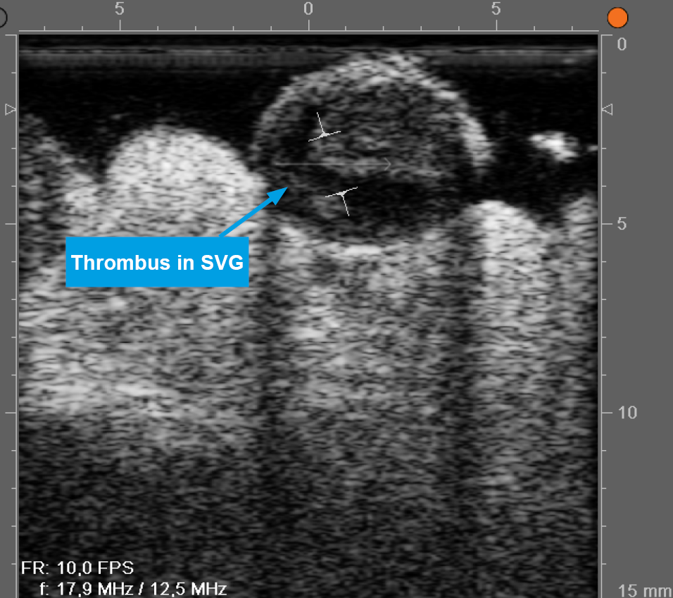 Detect Thrombus: TTFM & HFUS in Meso-Rex Shunt