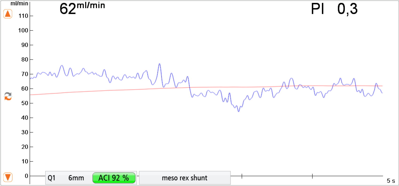 Detect Thrombus: TTFM & HFUS in Meso-Rex Shunt