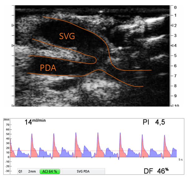 Anastomosis Insights: TTFM & HFUS Case Study | Medistim
