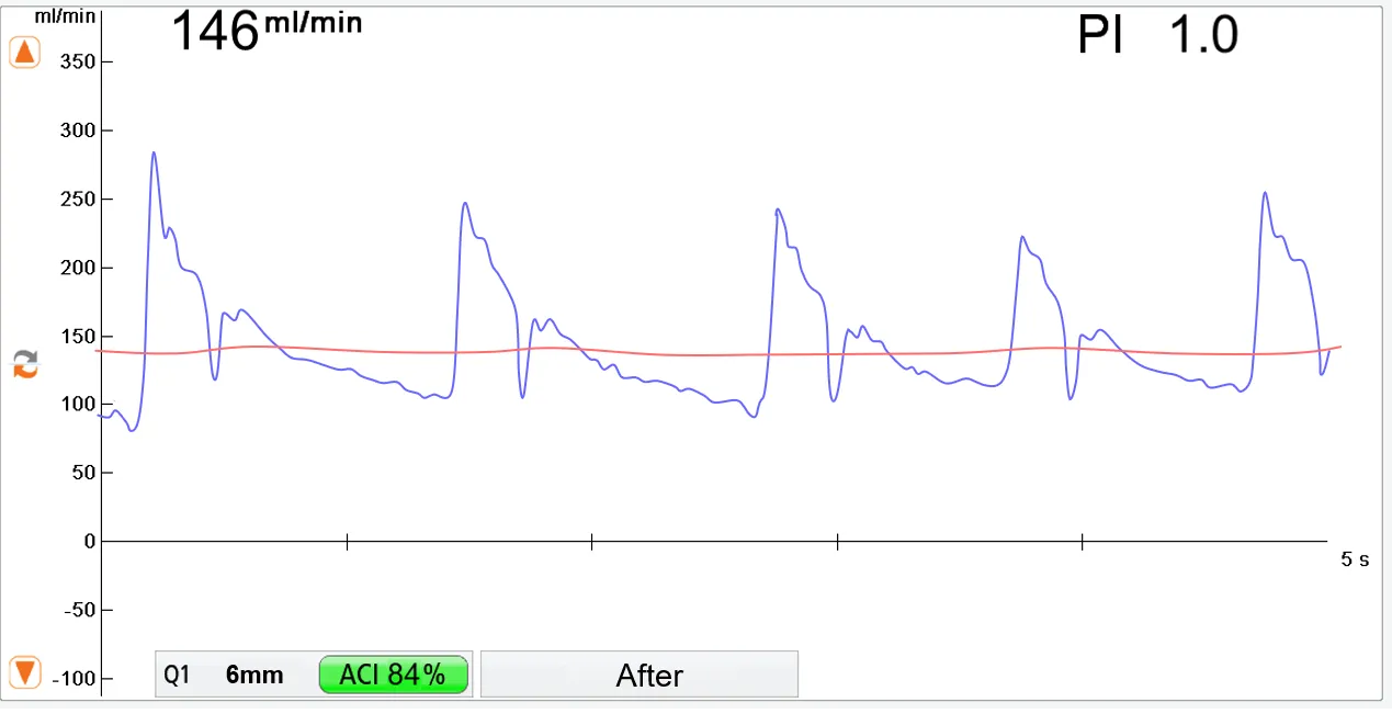 Optimal CEA Outcomes and Completion Control | Medistim