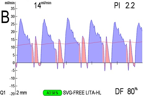 Medistim: TTFM's Role in Subclavian Steal Syndrome Management