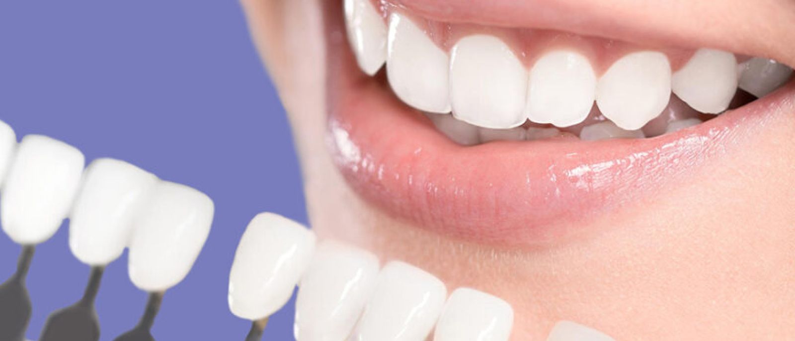 O que é e quanto custa para colocar facetas de resina?