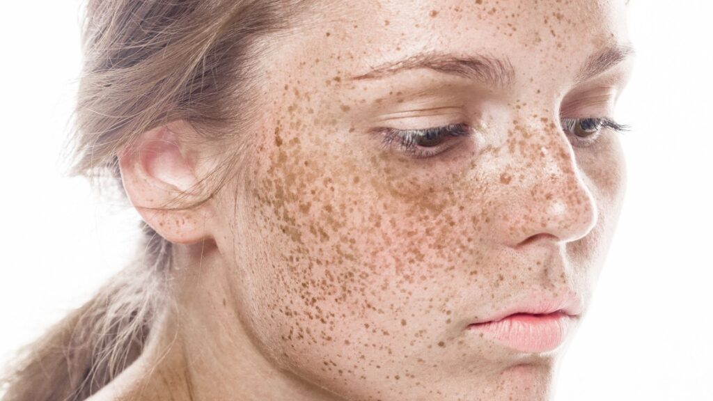 Learn About The 4 Types Of Skin Pigmentation - Plastic Surgery 128