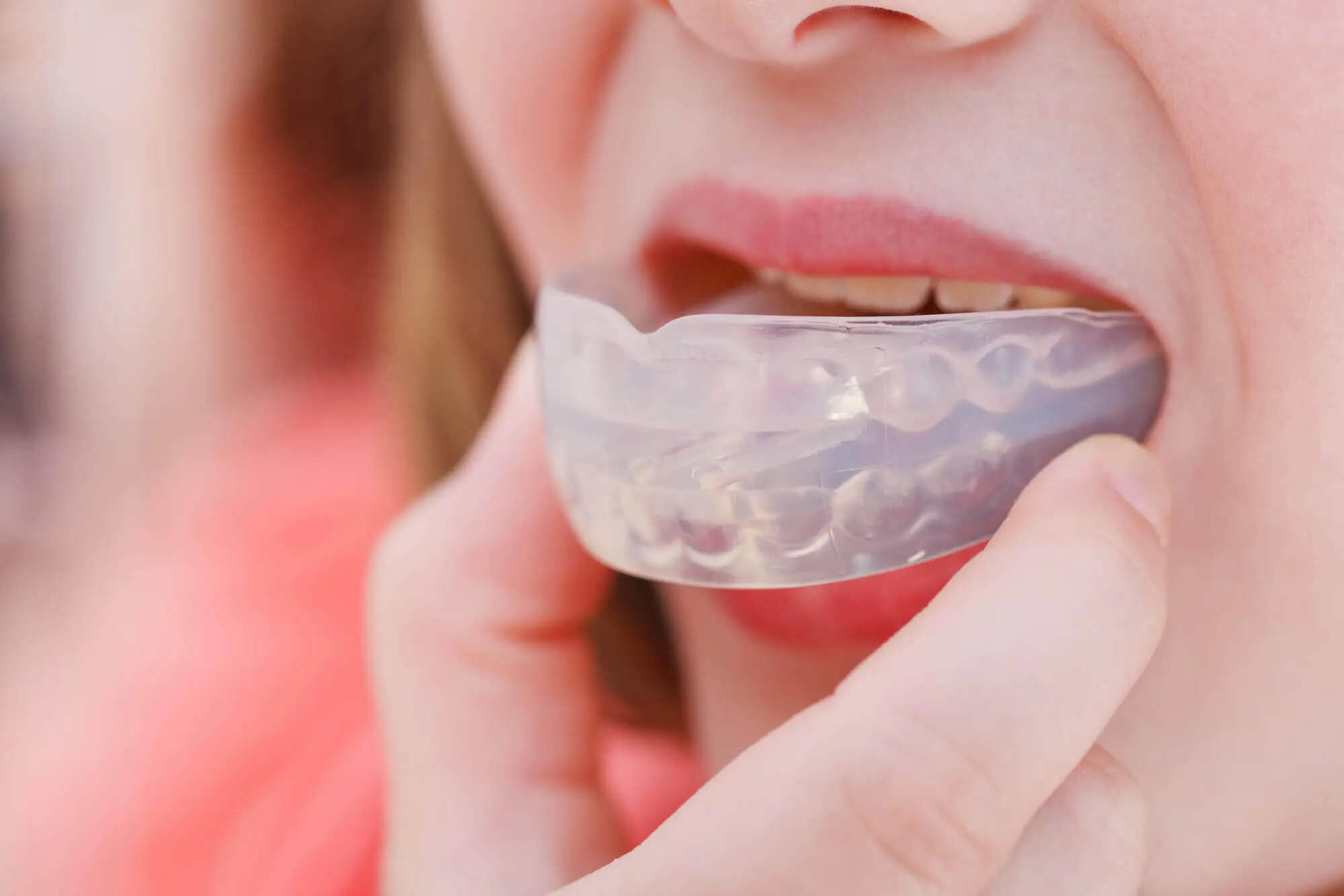 Mouthguards | Dental Wellness of Bartow