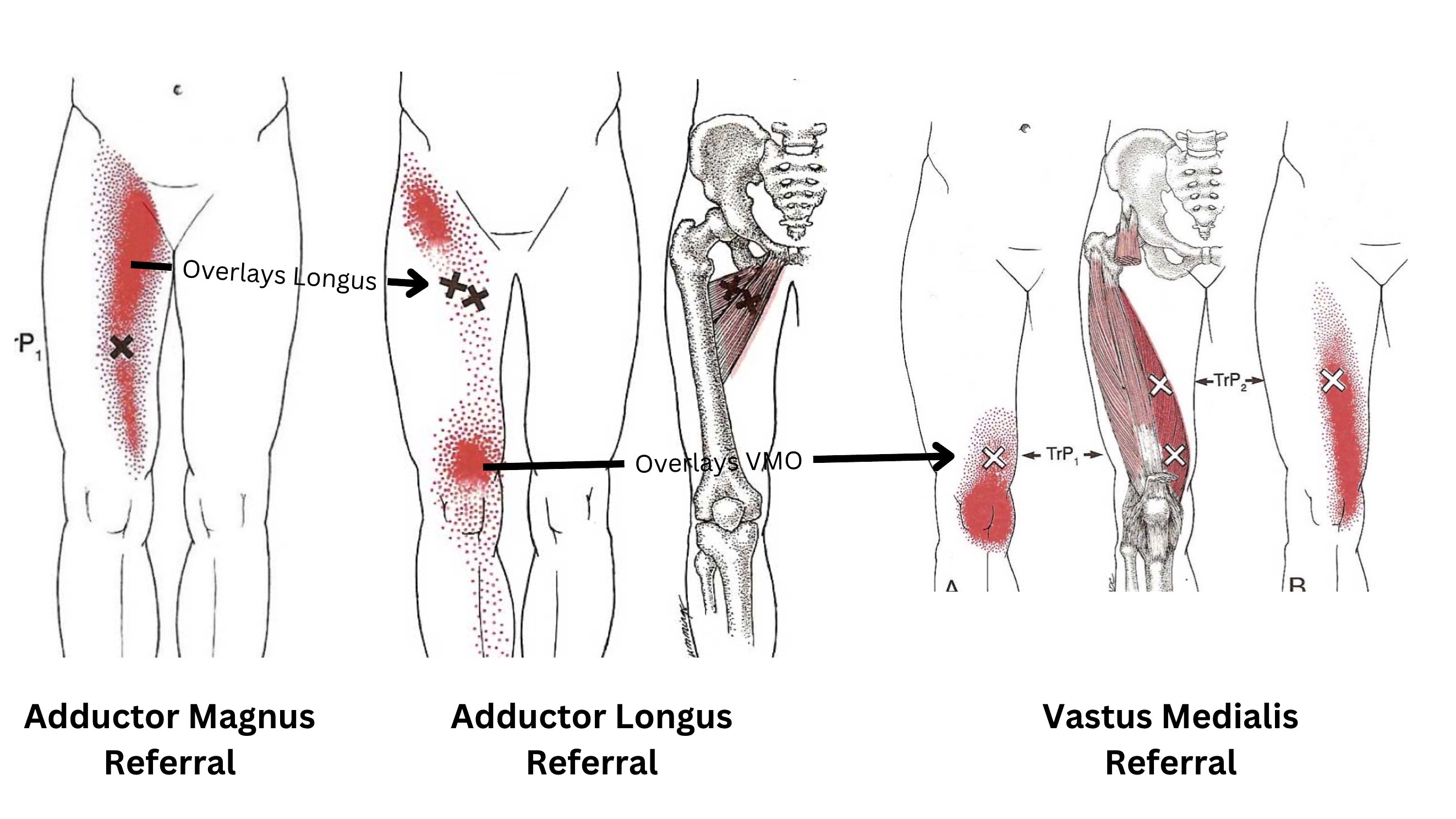 Chondromalacia Patella - Where Pain Referral Meets Function
