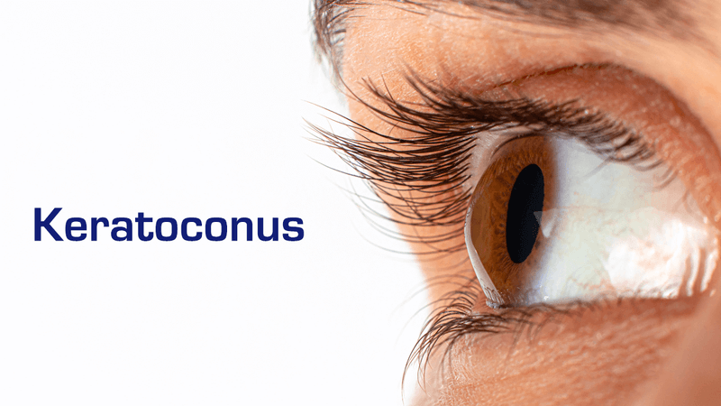 Keratoconus Ayurveda Acupuncture