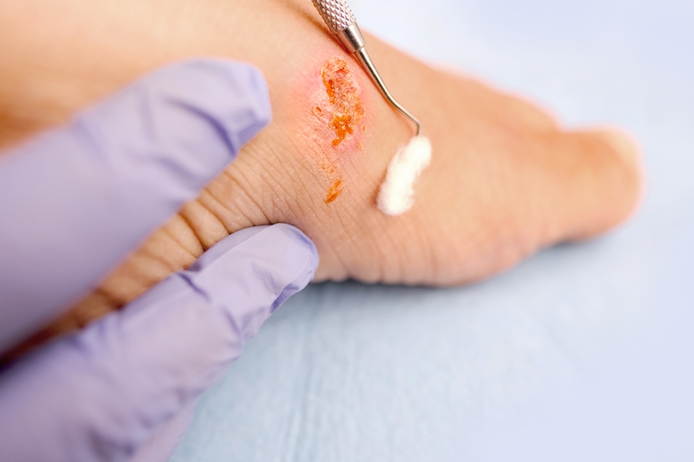 Wound Pathogen Testing