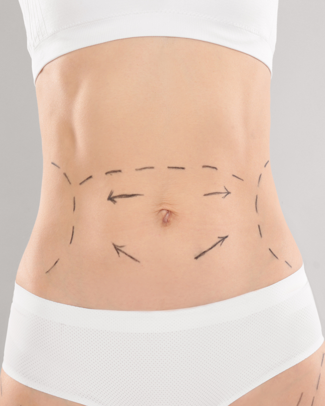 Endolift | SRGN Clinic