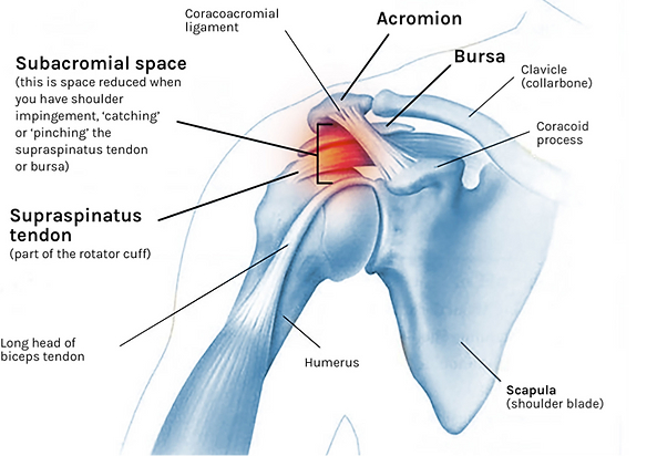 Shoulder Impingement: Causes & How to Fix It