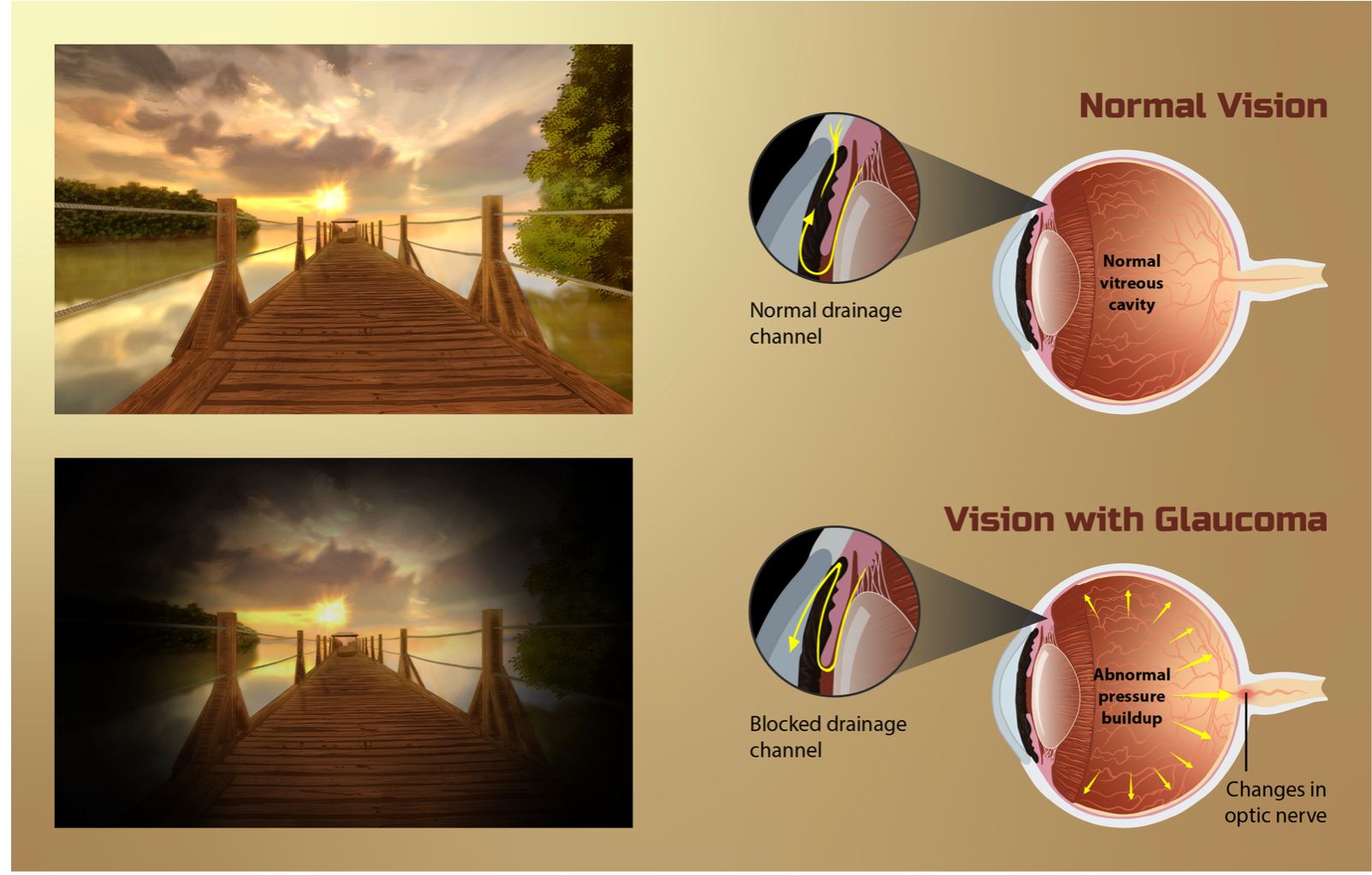 Glaucoma - An overview