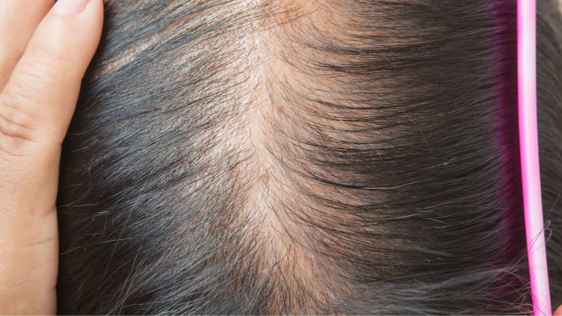 Decoding female hair loss and thinning