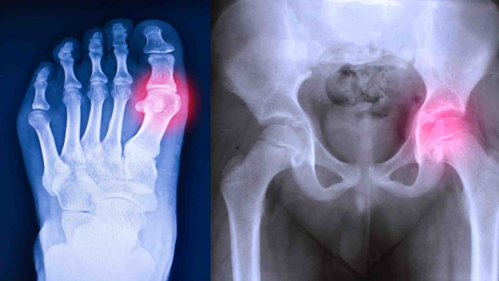 Arthritis, inflammation and how to avoid pain