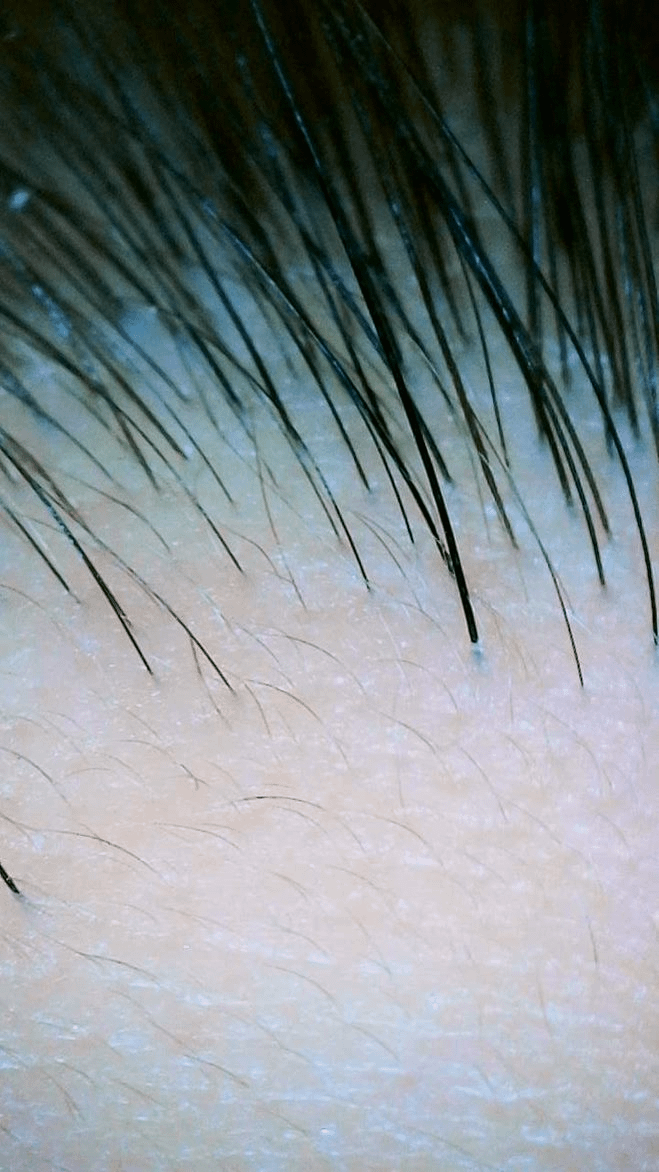 A Comprehensive Guide to "Am I Balding or Not?" - Hairly