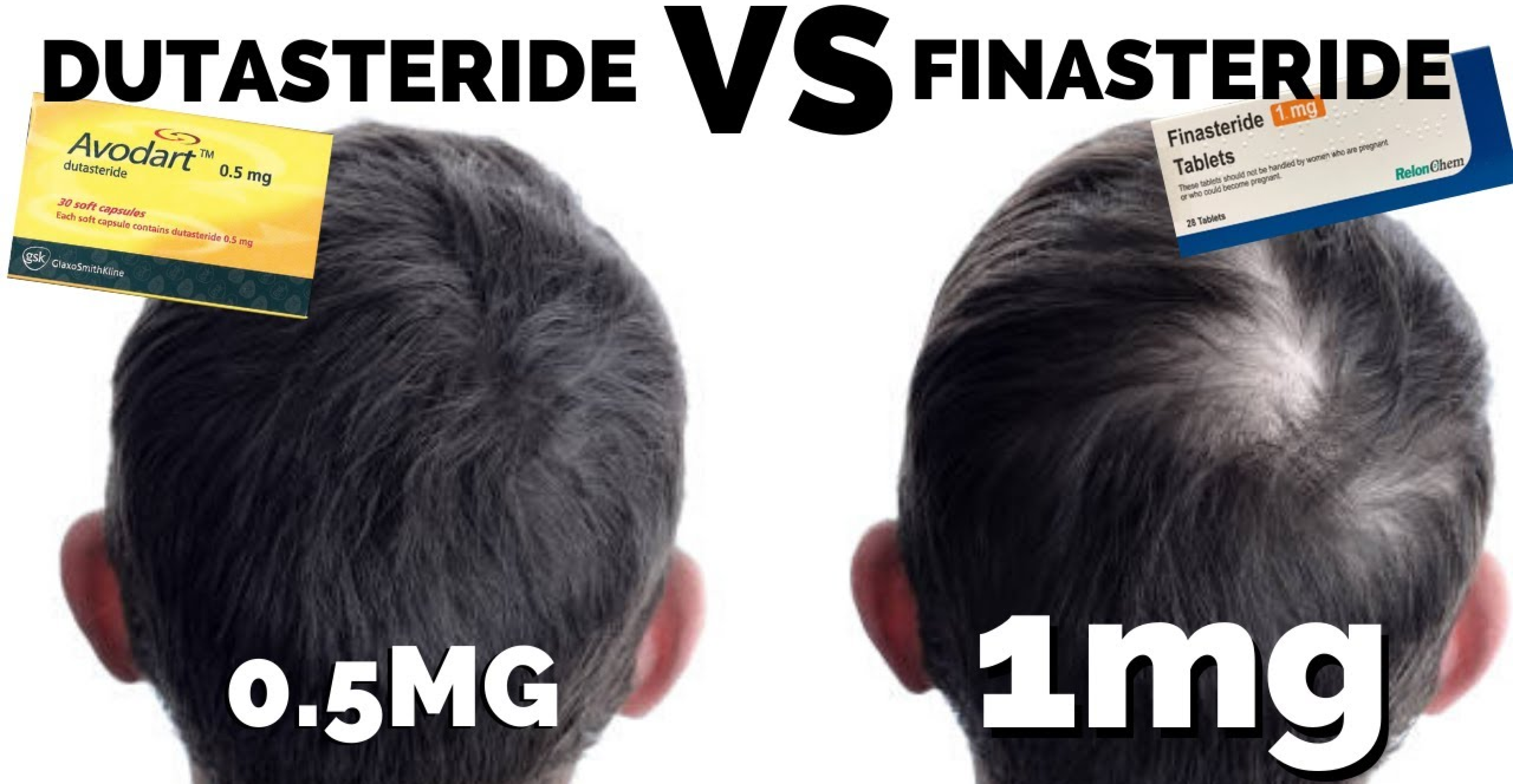 Topical Finasteride vs Oral Finasteride - Hairly