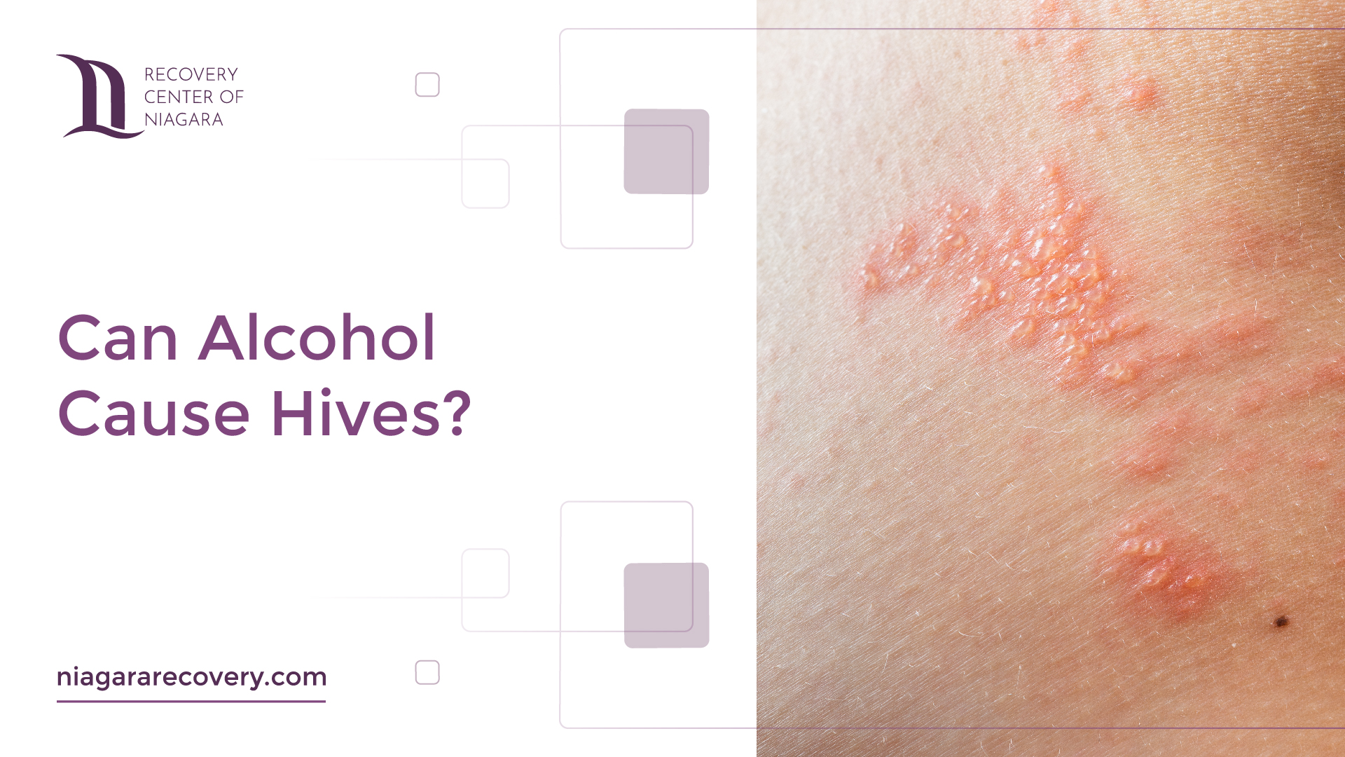 Can Alcohol Cause Hives?