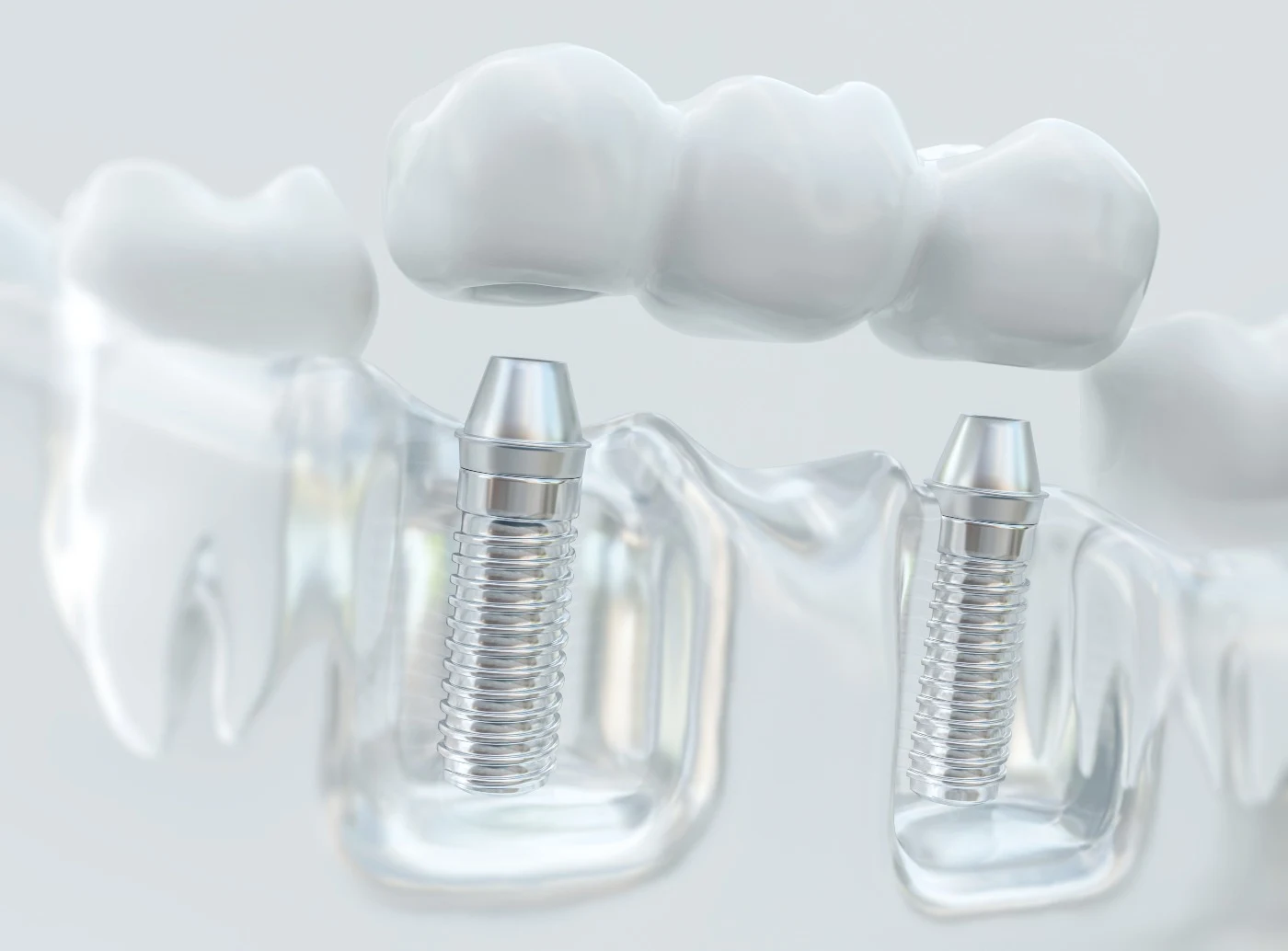Dental Implants in Plano | Star Ranch Dental