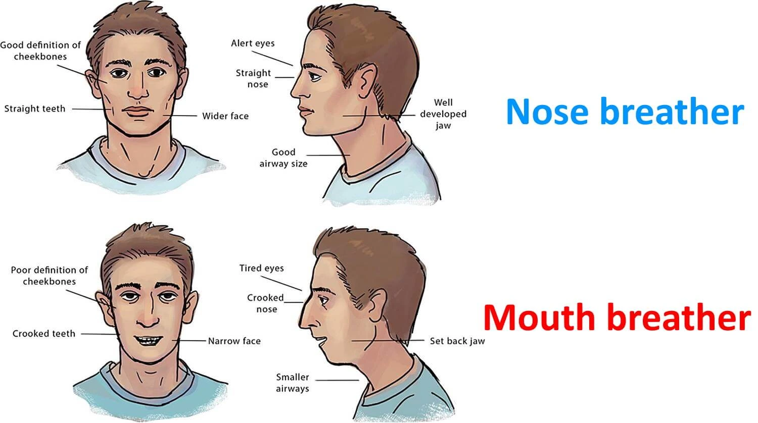 Mouth breathing and its significant health consequences