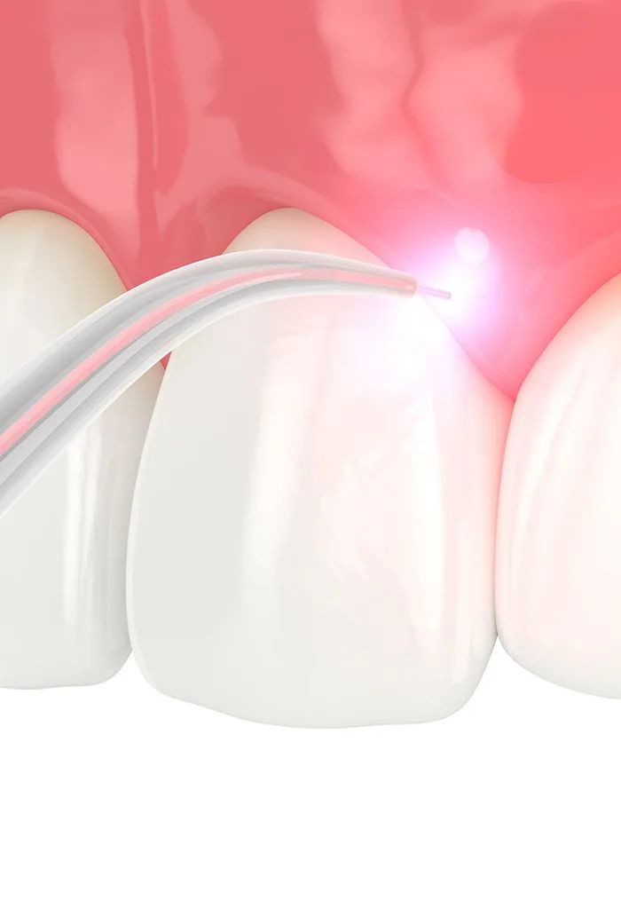 Soft-Tissue Therapy in East Houston | Northshore Dental