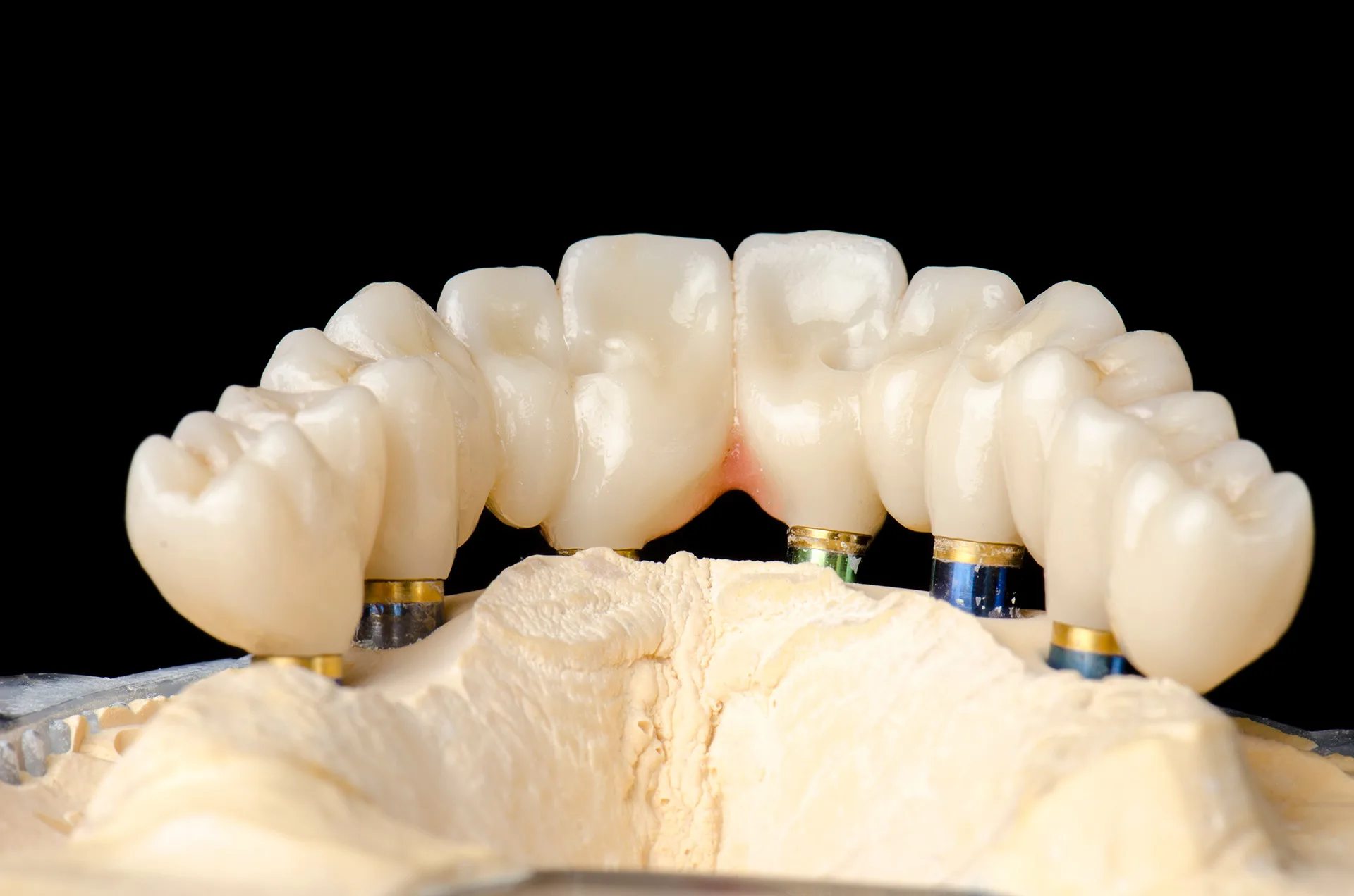 Full-Arch Implant Restorations in Houston | Northshore Dental