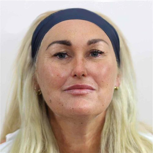 Aesthetic Treatment Results | Sisu Clinic