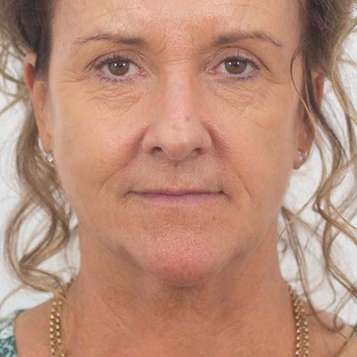 Aesthetic Treatment Results | Sisu Clinic